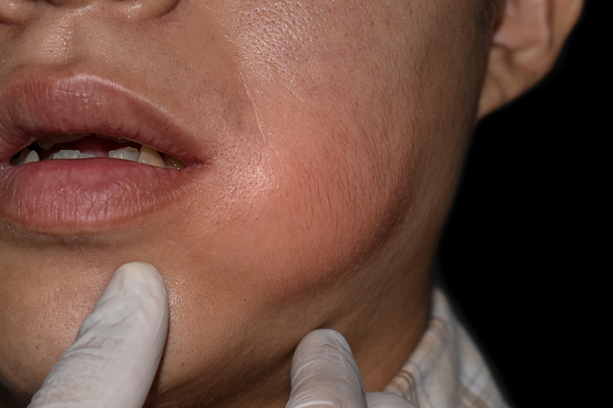 Abscessed Tooth in Phoenix or Gilbert? Get Same-Day Relief - Arizona ...