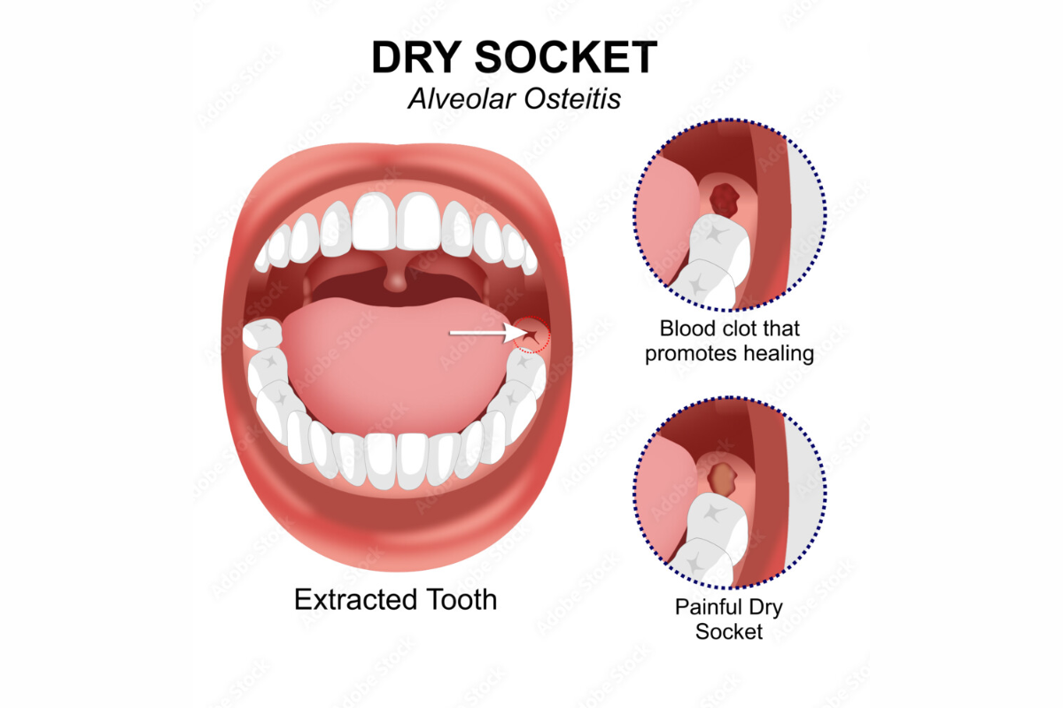 Our Top 5 Tips for How to Prevent Dry Socket - Arizona Dental Specialists