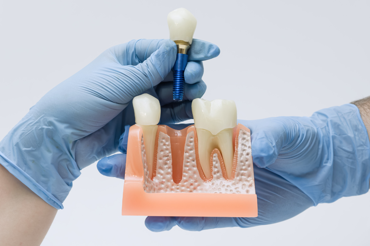 Dental Implant Timeline: Understanding the Dental Implant Process Step ...